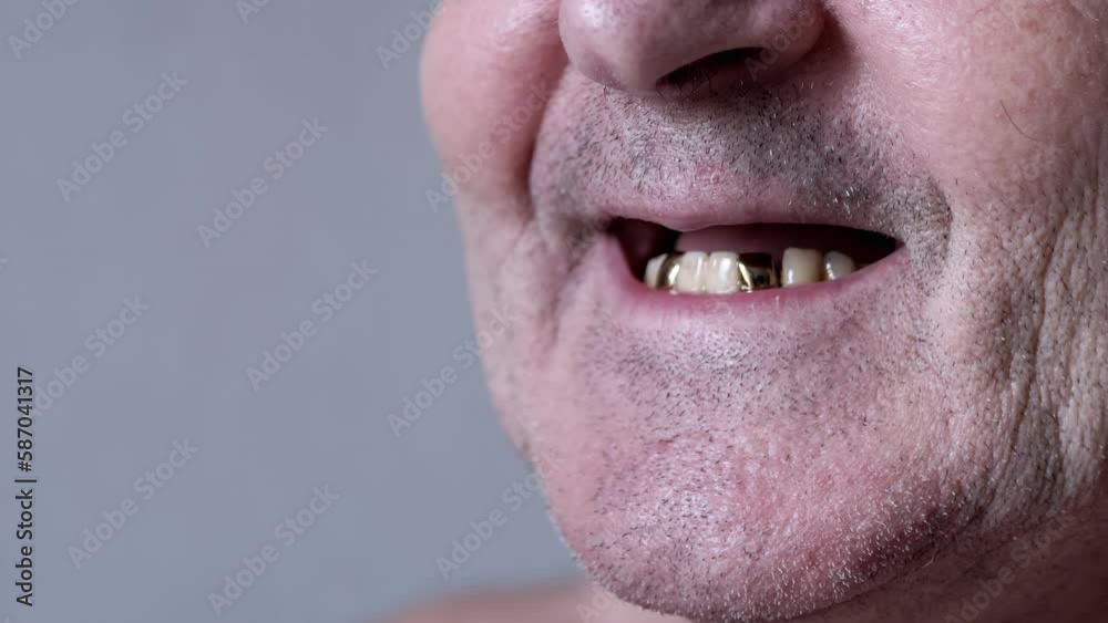 Close up, Smiling Toothless Old Elderly Male Takes Out Upper Denture ...