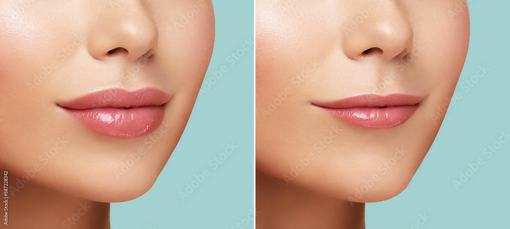 Comparison of women's lips filler correction before and after ...