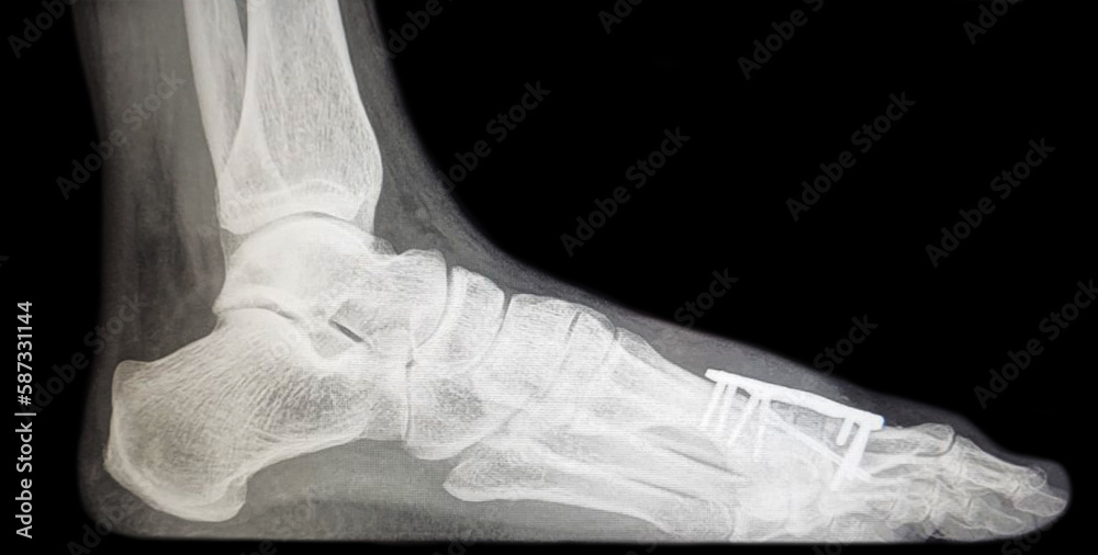 Xray image of Bone block distraction arthrodesis - MTP1 of the hallux ...
