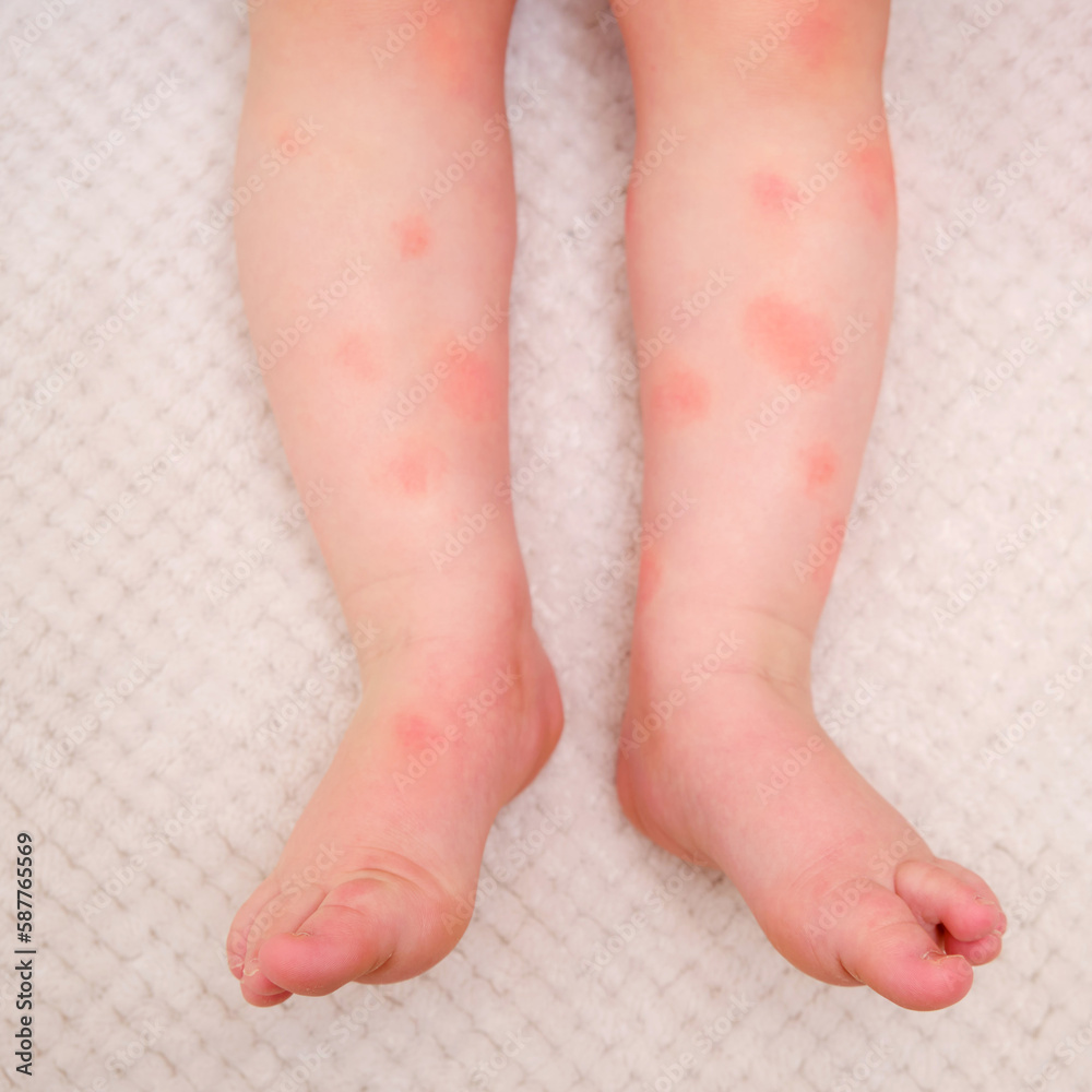 Toddler baby skin care, allergies and dermatitis. Red spots of allergy ...