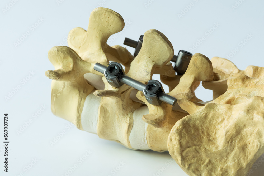 Model of instrument fixation of lumbar spine Stock Photo | Adobe Stock