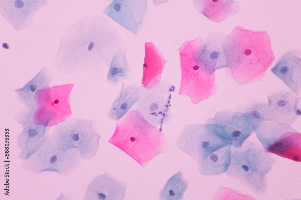 View in microscopic of Candidiasis, fungus infection (Yeast and ...