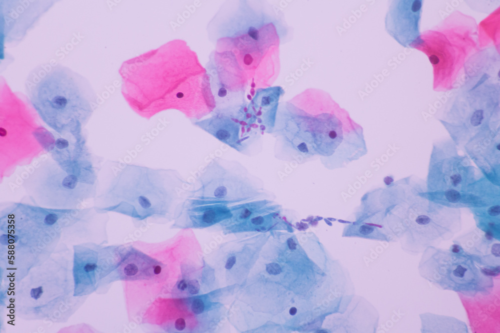 View in microscopic of Candidiasis, fungus infection (Yeast and ...