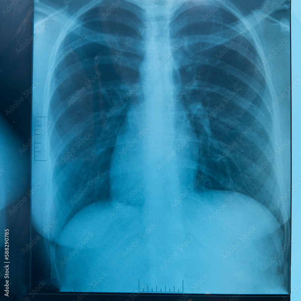 Human lung x-ray analysis, doctor examines lung disease. Pneumonia ...