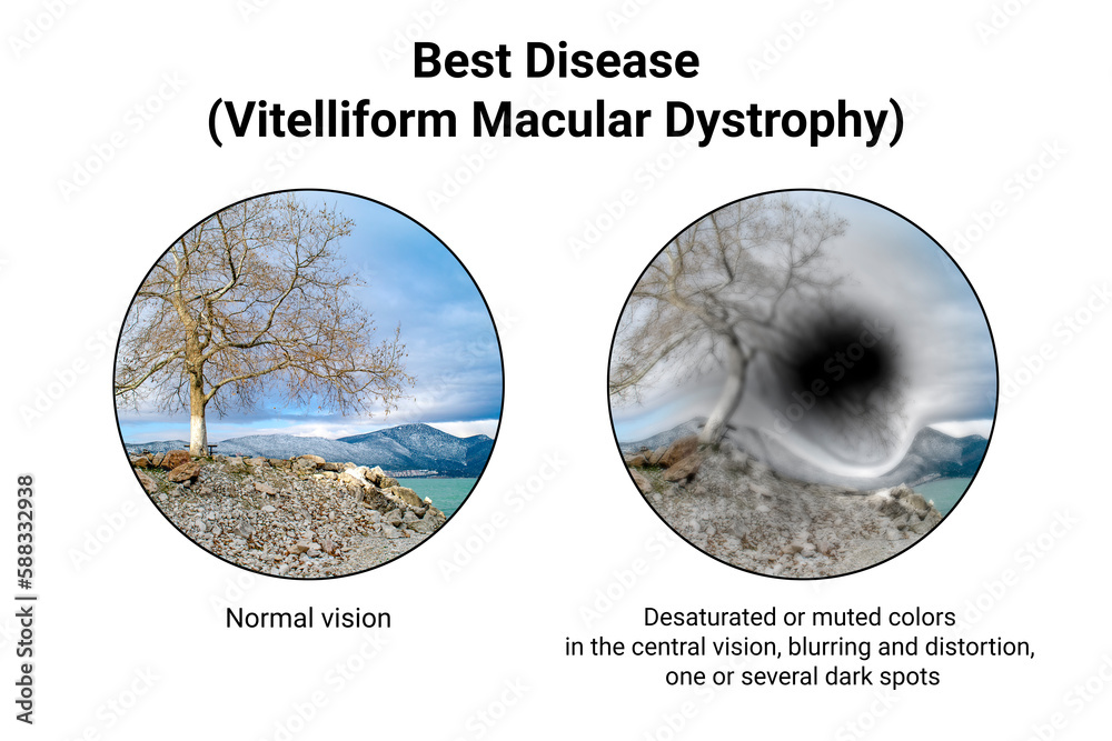 The difference between the vision of a normal eye and an eye affected ...
