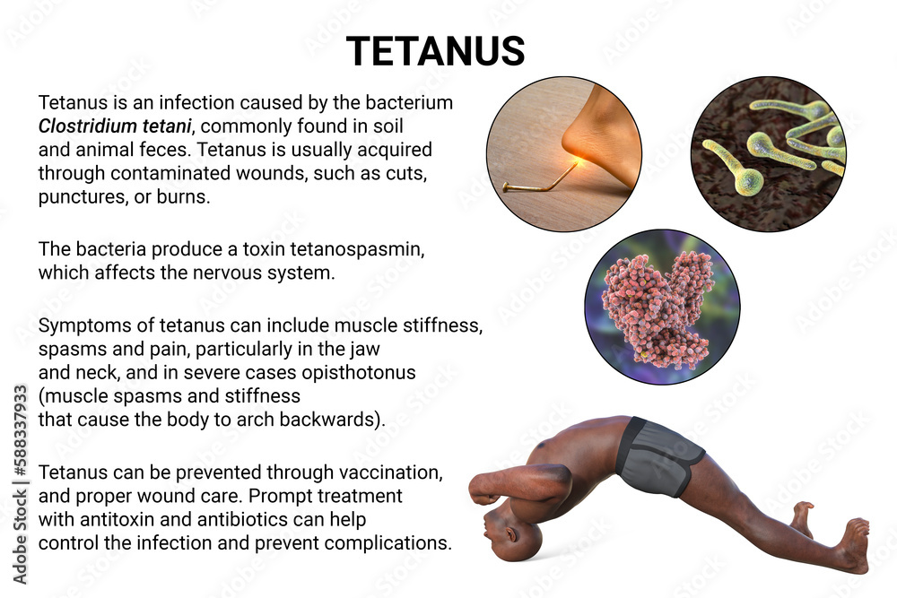 Mechanism of tetanus disease, 3D illustration Stock Illustration ...