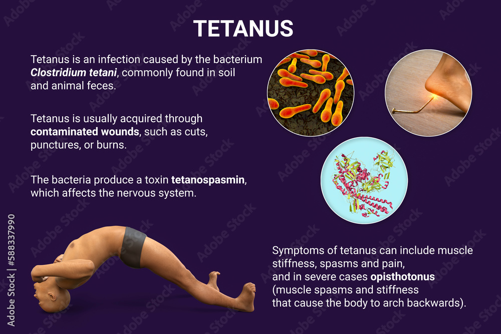 Mechanism of tetanus disease, 3D illustration Stock Illustration ...