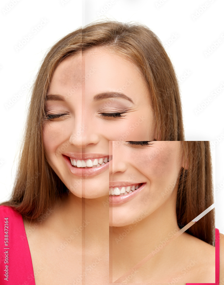 Dark spots, freckles,hyperpigmentation(melasma or chloasma),concept ...