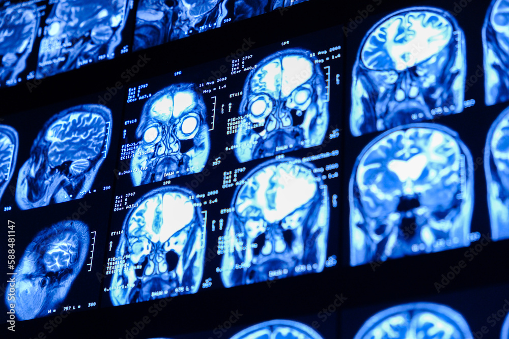 Close-up of CT scan with brain. Medicine, science and education MRI ...