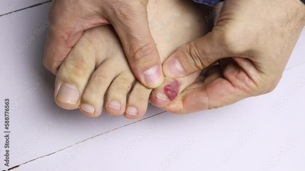 kneads the foot on the toe where the blood blister has formed vídeo do ...