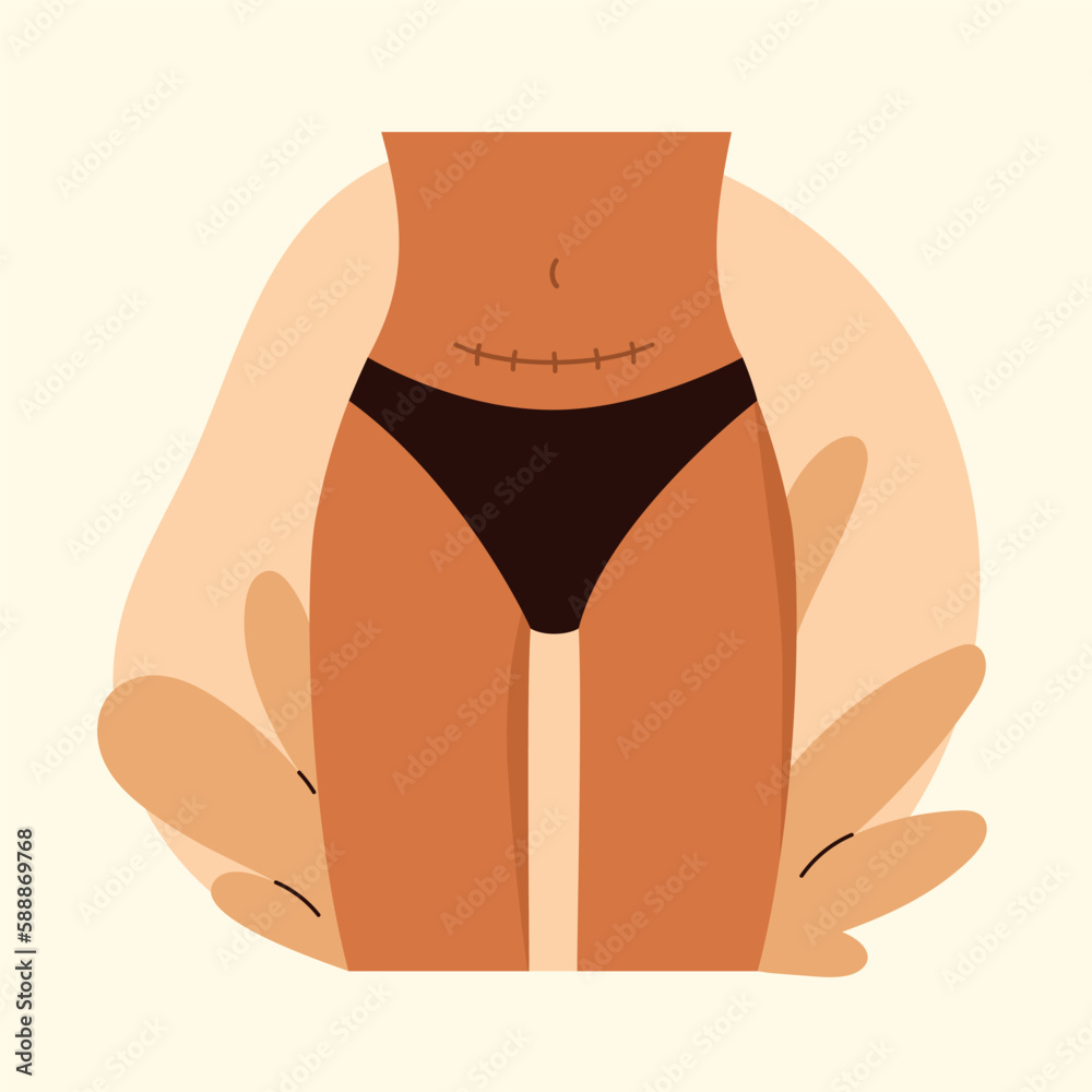Cesarean Scar Stitches After Caesarean Section On Female Belly C Section Surgical Delivery