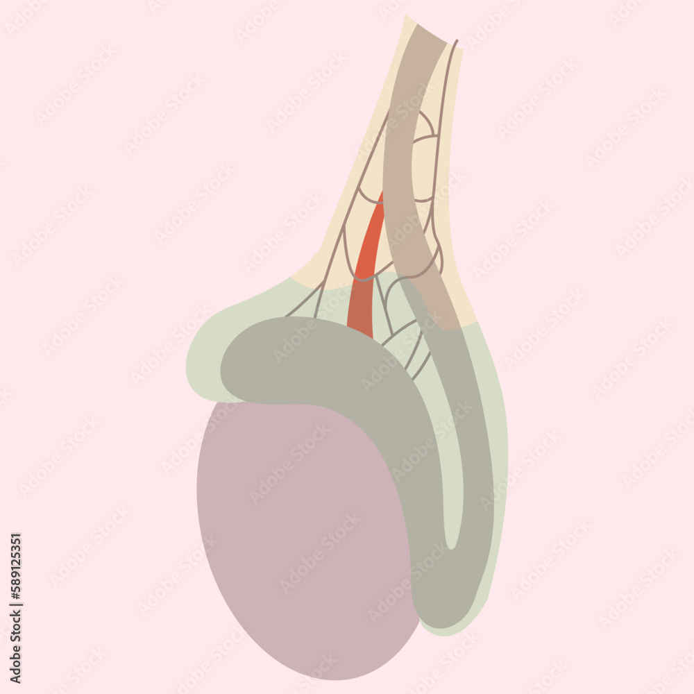 Illustration Of A Hydrocele A Common Medical Condition That Affects