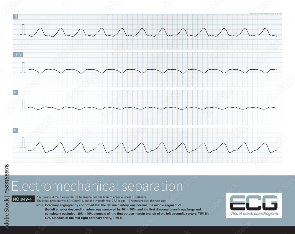 Electromechanical separation is a kind of terminal ECG. The patient's ...
