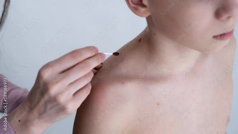 Mom lubricates the rash from chickenpox on son's body and back with ...