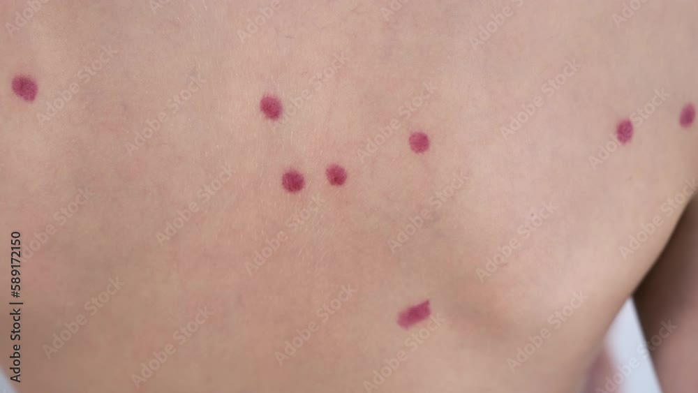 Lubricated rash from chickenpox varicella on teen boy's body with red ...