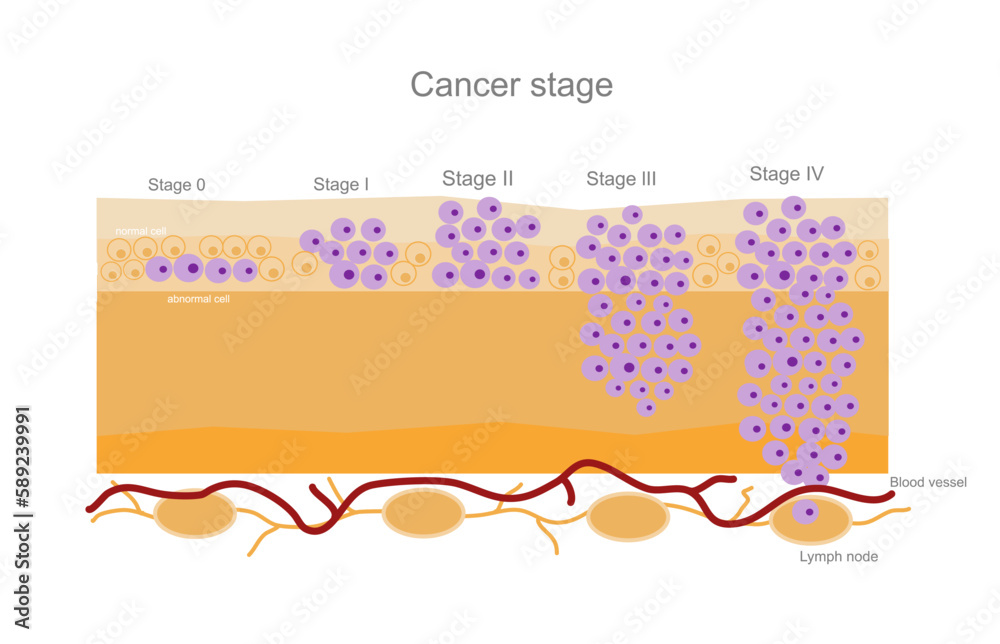 Poster The cancer stage (0 - VI) that represents the abnormal cell in ...