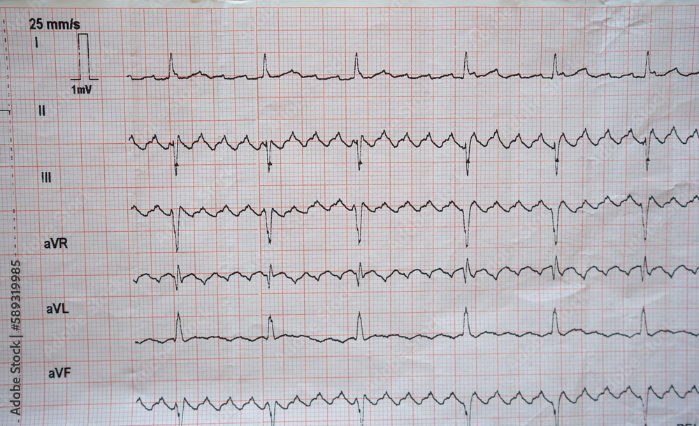Photo & Art Print real ecg showing atrial flutter (good to see in ...