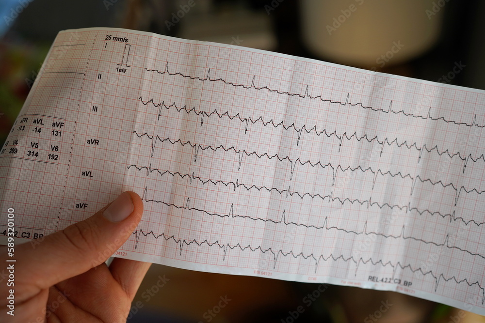 Hand holding a real electrocardiogram with atrial flutter. Stock Photo ...
