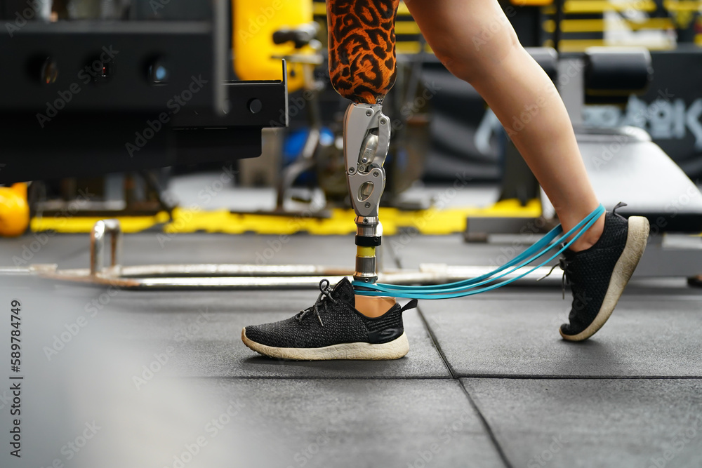 Young female with one prosthetic leg with exercise by walking on a ...