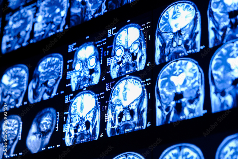 MRI scan of the brain for diagnosis. Medical examination for health ...