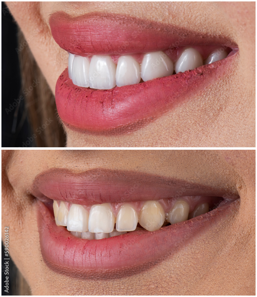 before and after picture of ceramic restorations on teeth by emax and ...