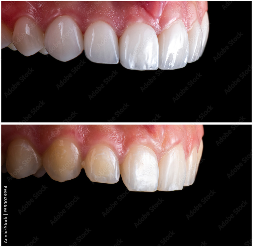 before and after picture of ceramic restorations on teeth by emax and ...