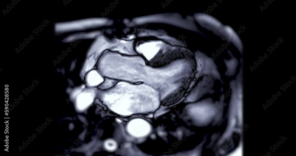 MRI of heart or Cardiac MRI ( magnetic resonance imaging ) of heart ...