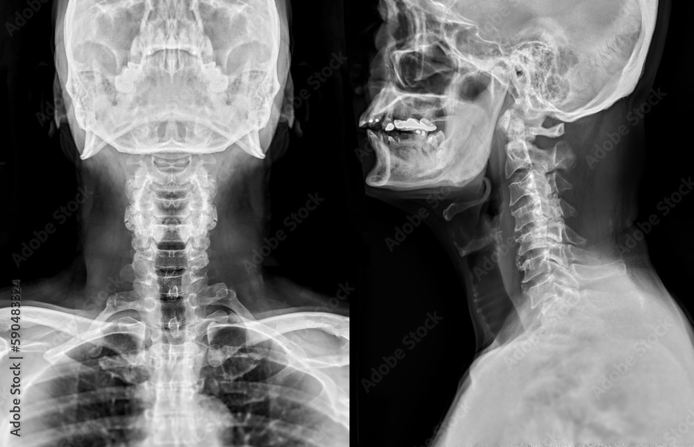 X-ray C-spine or x-ray image of Cervical spine AP and Lateral view for ...