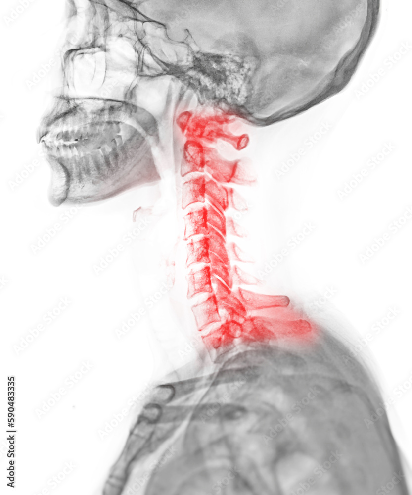 Póster X-ray C-spine or x-ray image of Cervical spine lateral view for ...