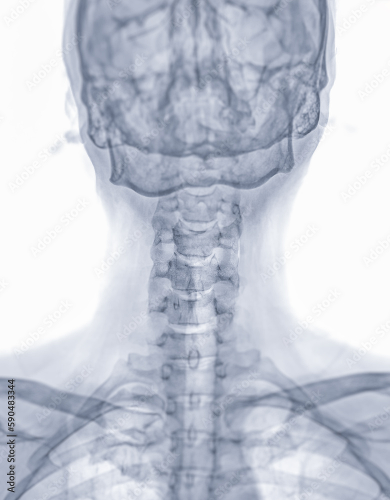 X-ray C-spine or x-ray image of Cervical spine lateral view for ...