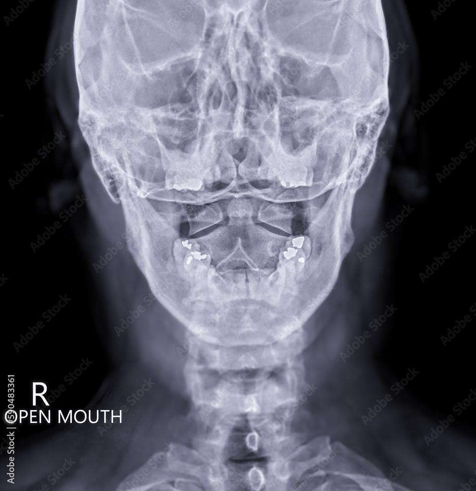 X Ray C Spine Or X Ray Image Of Cervical Spine Open Mount View For Fracture Of Cervical Vertebra