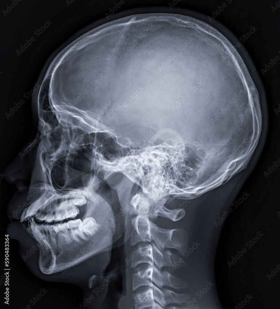 x-ray image of Human Skull lateral view for diagnosis skull fracture ...