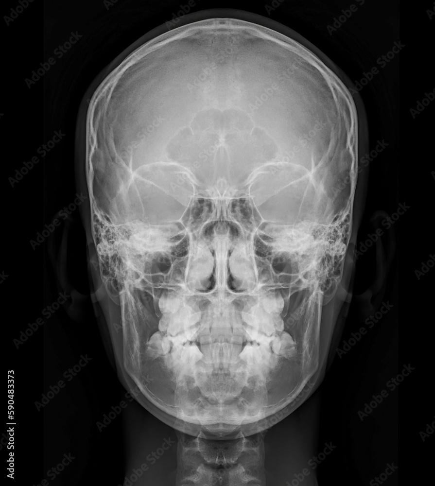 X-ray image of Human Skull Front view for diagnosis skull fracture ...