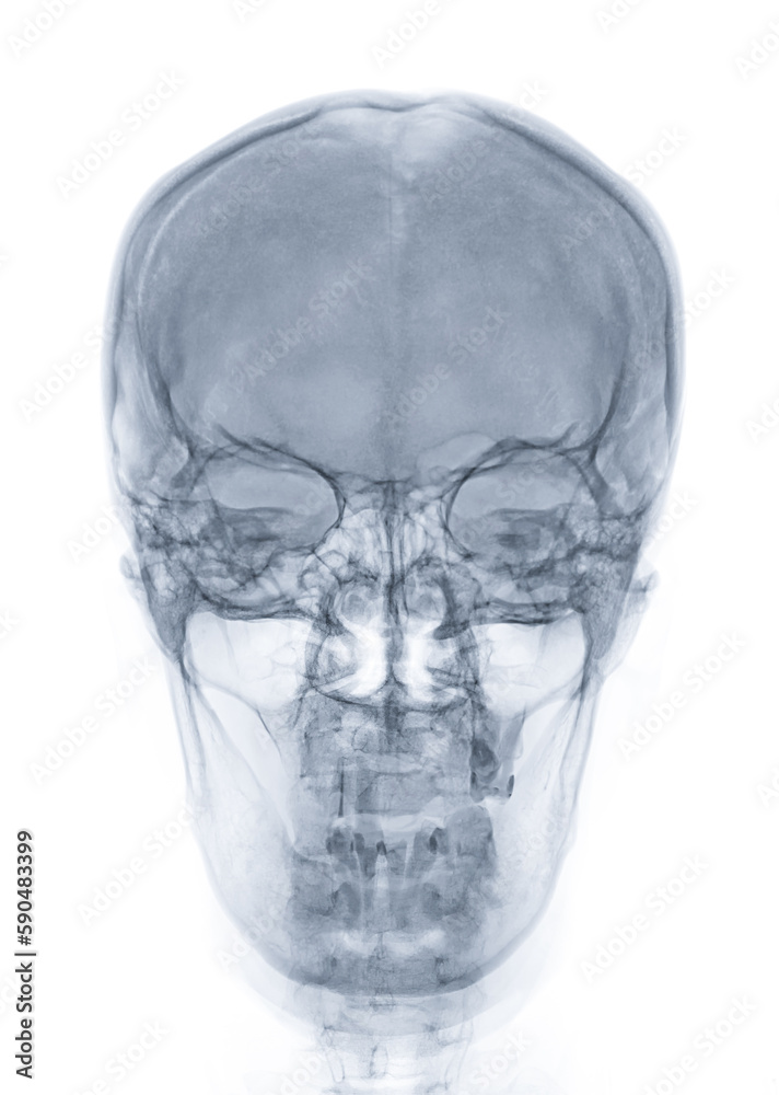 X-ray image of Human Skull Front view for diagnosis skull fracture ...