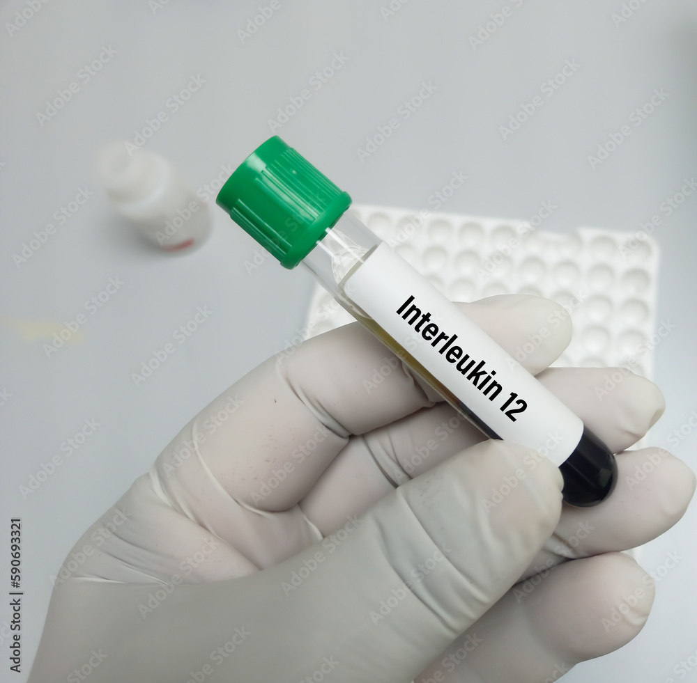 Blood sample for Interleukin 12 or IL-12 test, Pro-inflammatory ...