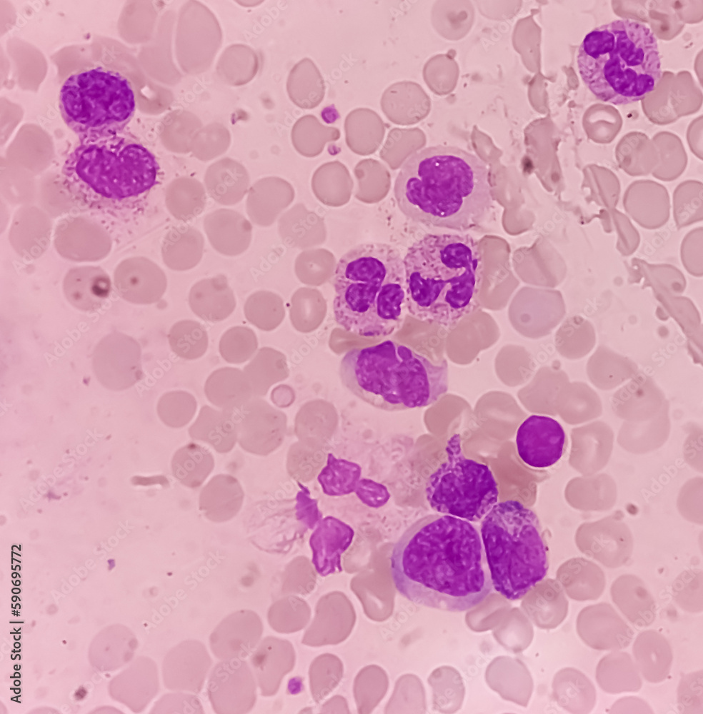Blood cancer. Chronic myeloid leukemia(CML) with Thrombocytopenia ...