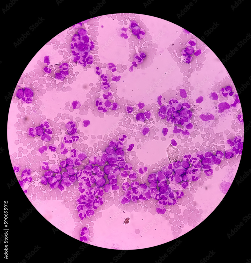 Blood cancer. Chronic myeloid leukemia(CML) with Thrombocytopenia ...