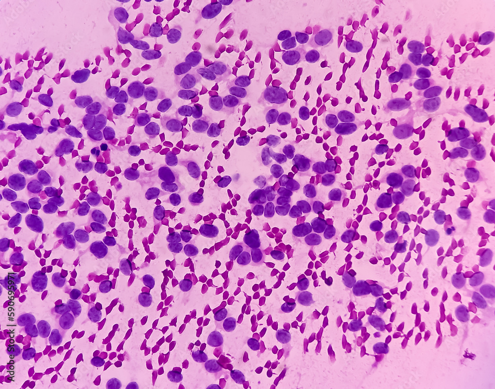 USG guided FNA cytology from liver SOL. Non-Hodgkin lymphoma. Smear ...