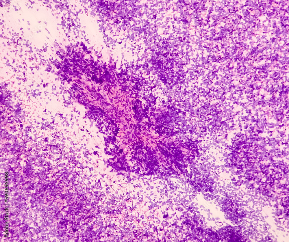 USG guided FNA cytology from liver SOL. Non-Hodgkin lymphoma. Smear ...