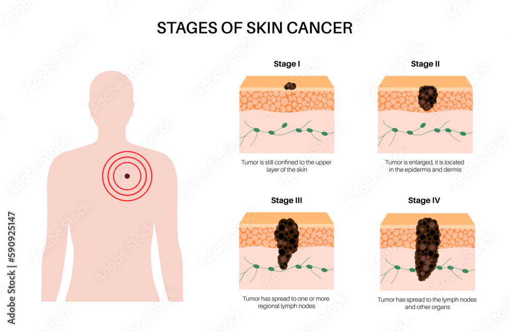 Melanoma Stages Poster Stock Vector Adobe Stock