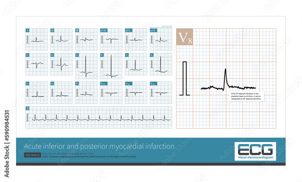 Distal occlusion of the right coronary artery can cause inferior and ...