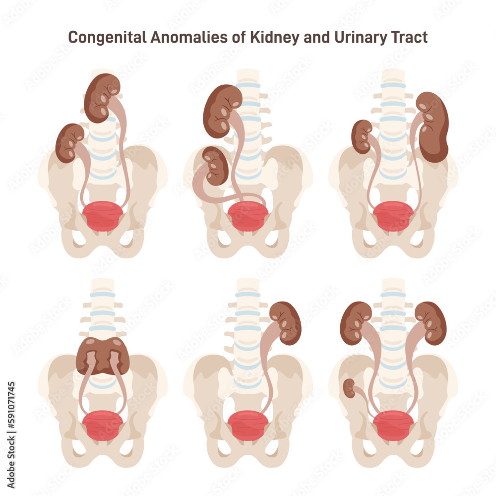Congenital anomaly of kidneys set. Urinary system organ inborn Stock ...