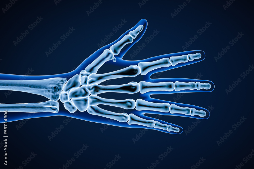 X-ray dorsal or posterior view of right human hand bones with body ...