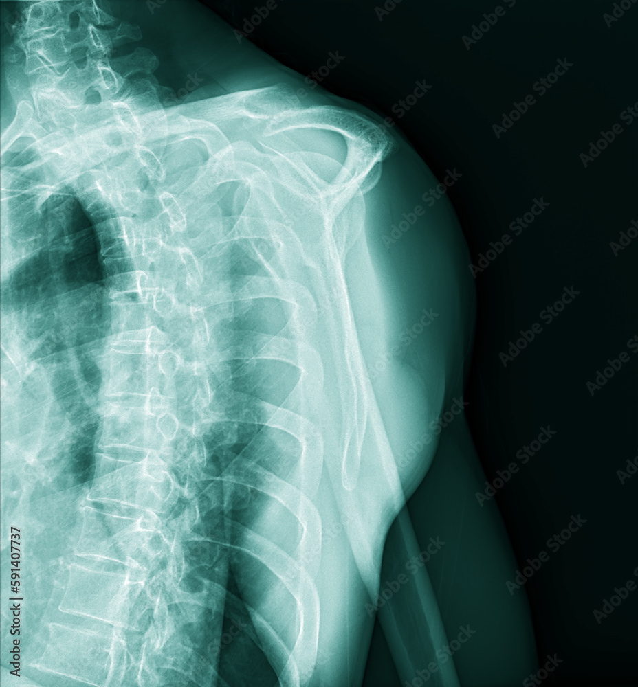 x-ray image of the shoulder for medical diagnosis Stock Photo | Adobe Stock