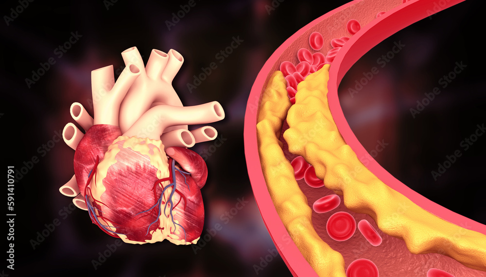 Cholesterol plaque in artery with human heart anatomy. 3d illustration ...