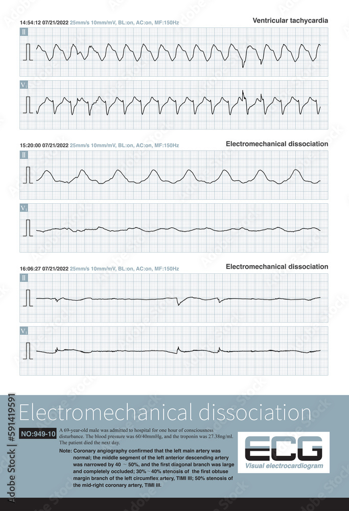 A patient with acute extensive anterior myocardial infarction developed ...