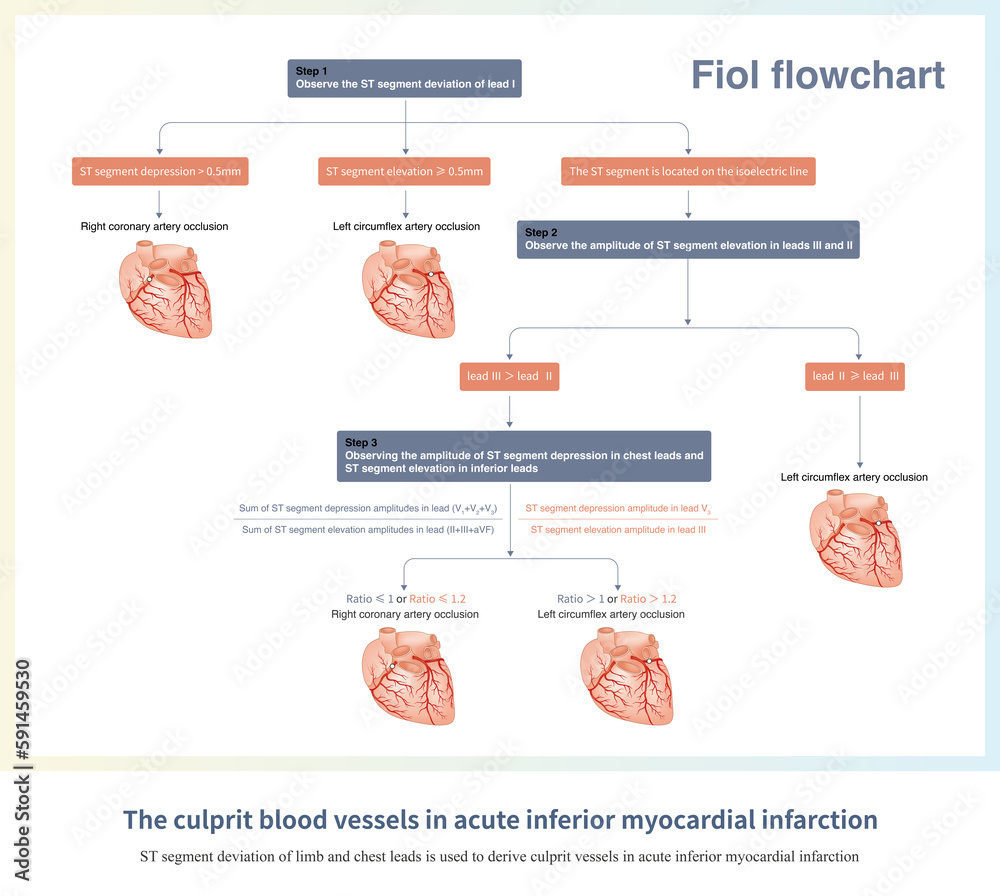 When acute inferior myocardial infarction occurs, the ST segment offset ...