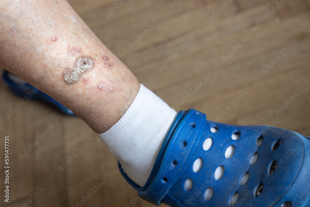 Ulcers and skin diseases, dried scabs and fresh wounds on the legs of ...