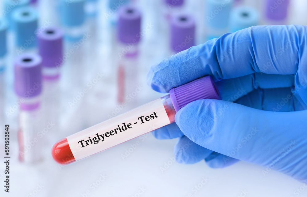 Doctor holding a test blood sample tube with Triglyceride test on the ...