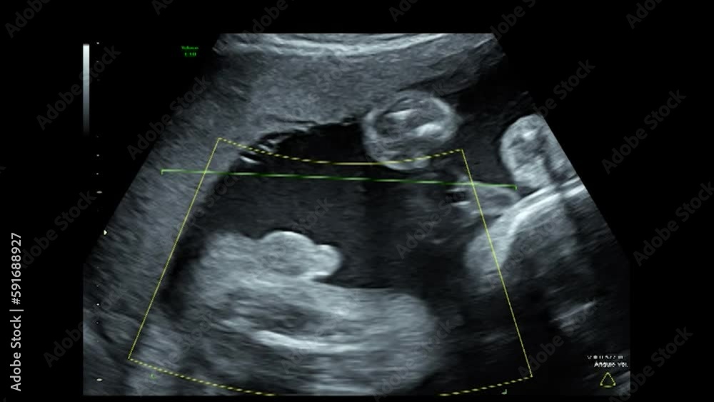 Ultrasound echography where it is possible to see the genitals of a 6 ...